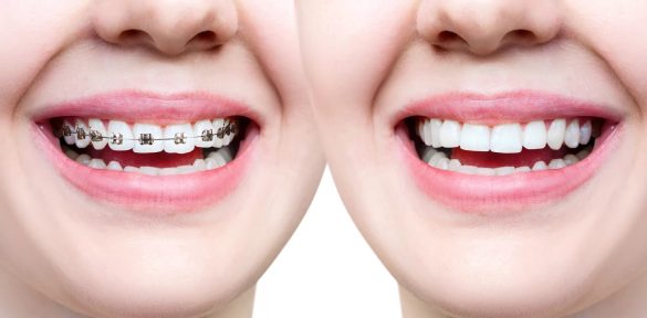 The Evolution of Orthodontic Technology: From Metal Braces to Clear ...